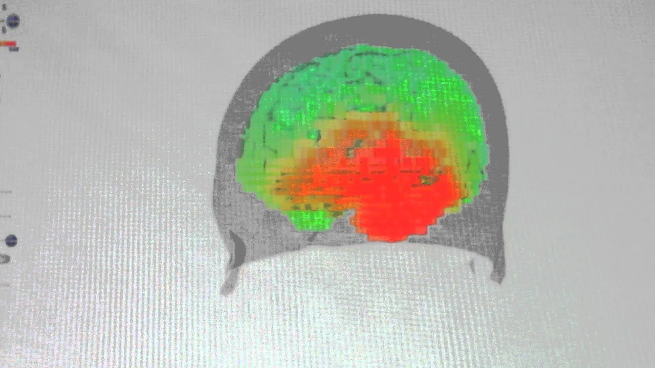 Value of live brain activation imaging in neurology and cognitive ...