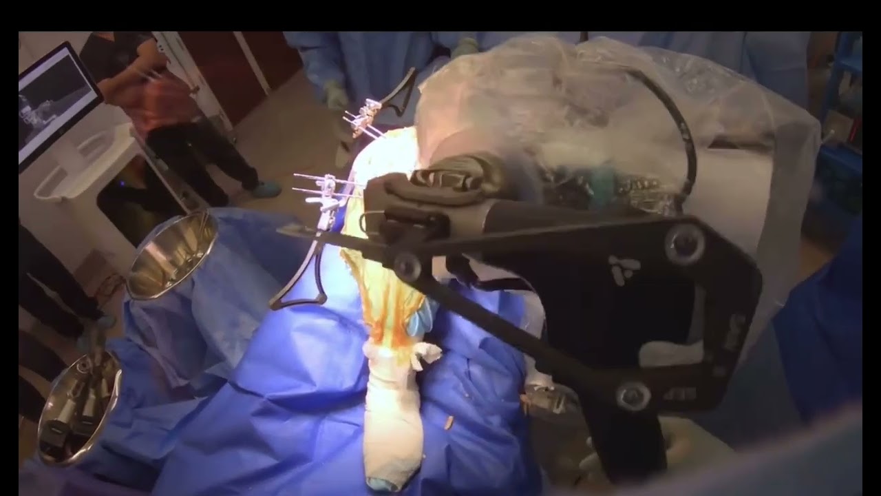 Femoral Resections - YouTube