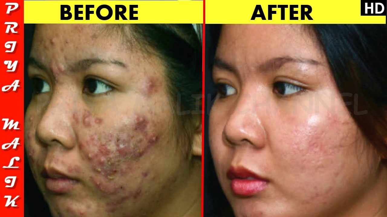 Remove Pimples Overnight Acne Treatment Priya Malik Youtube