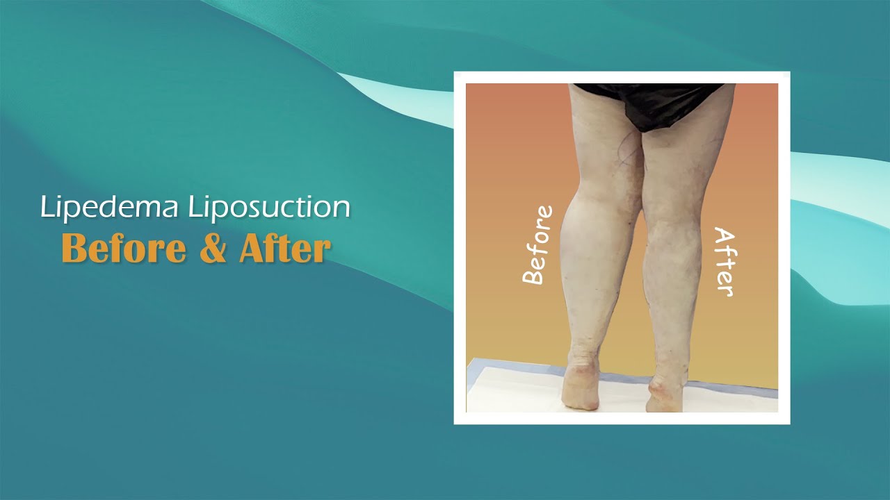 Before & After Lipedema Leg Liposuction | Immediate Results | Expert Dr ...