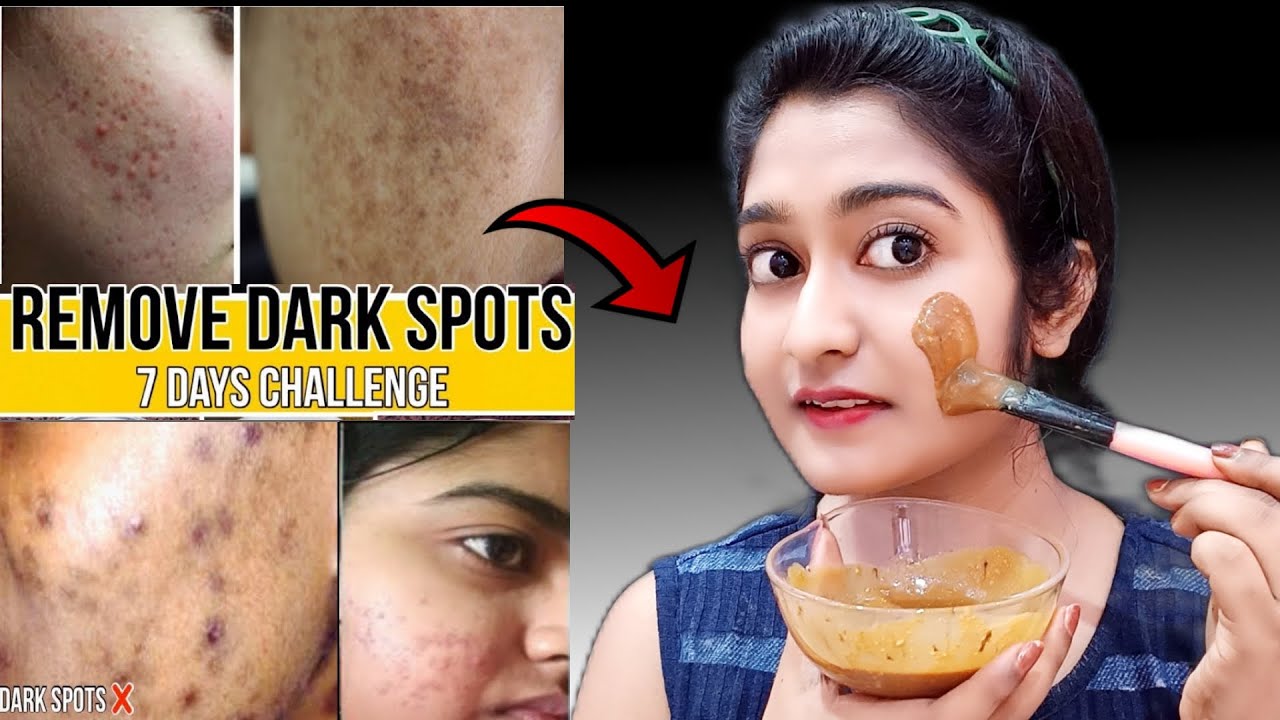 Best face pack for pimple and dark spots | 7 days challenge ...