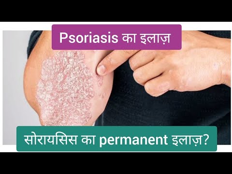 Psoriasis treatment | सोरायसिस का permanent इलाज़ | #psoriasis # ...