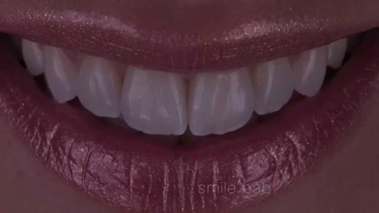 Esthetic rehabilitation with ceramic veneers by D-r Sofien Riahi and MDT Stefan Petrov - YouTube