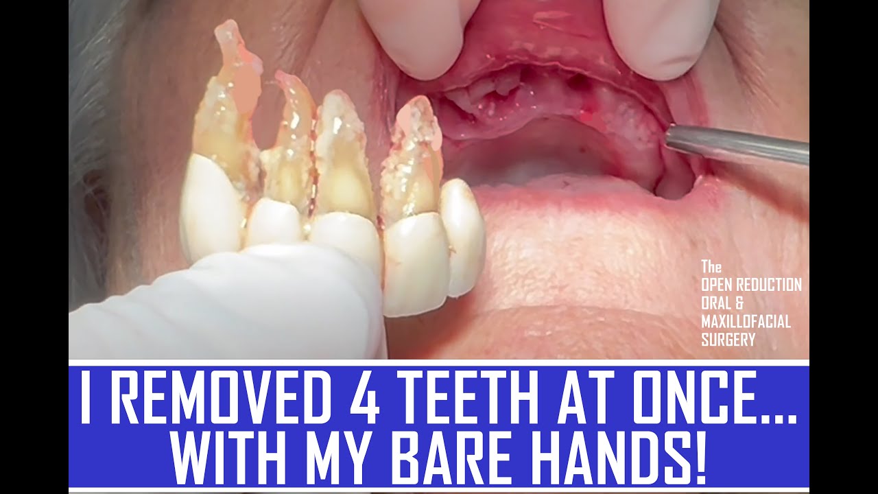 I Removed 4 Teeth at Once...With My Bare Hands! - YouTube