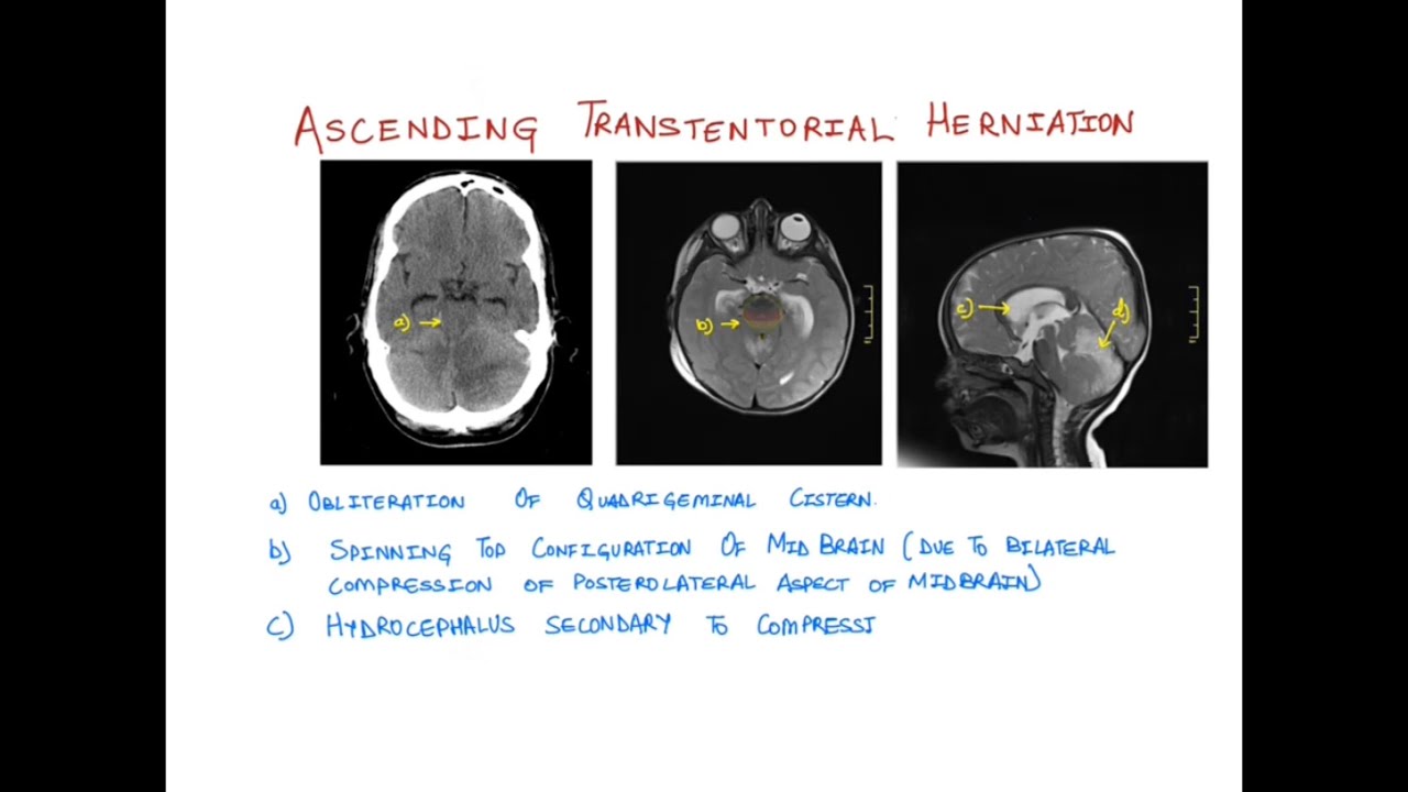 Ascending transtentorial herniation #shorts - YouTube
