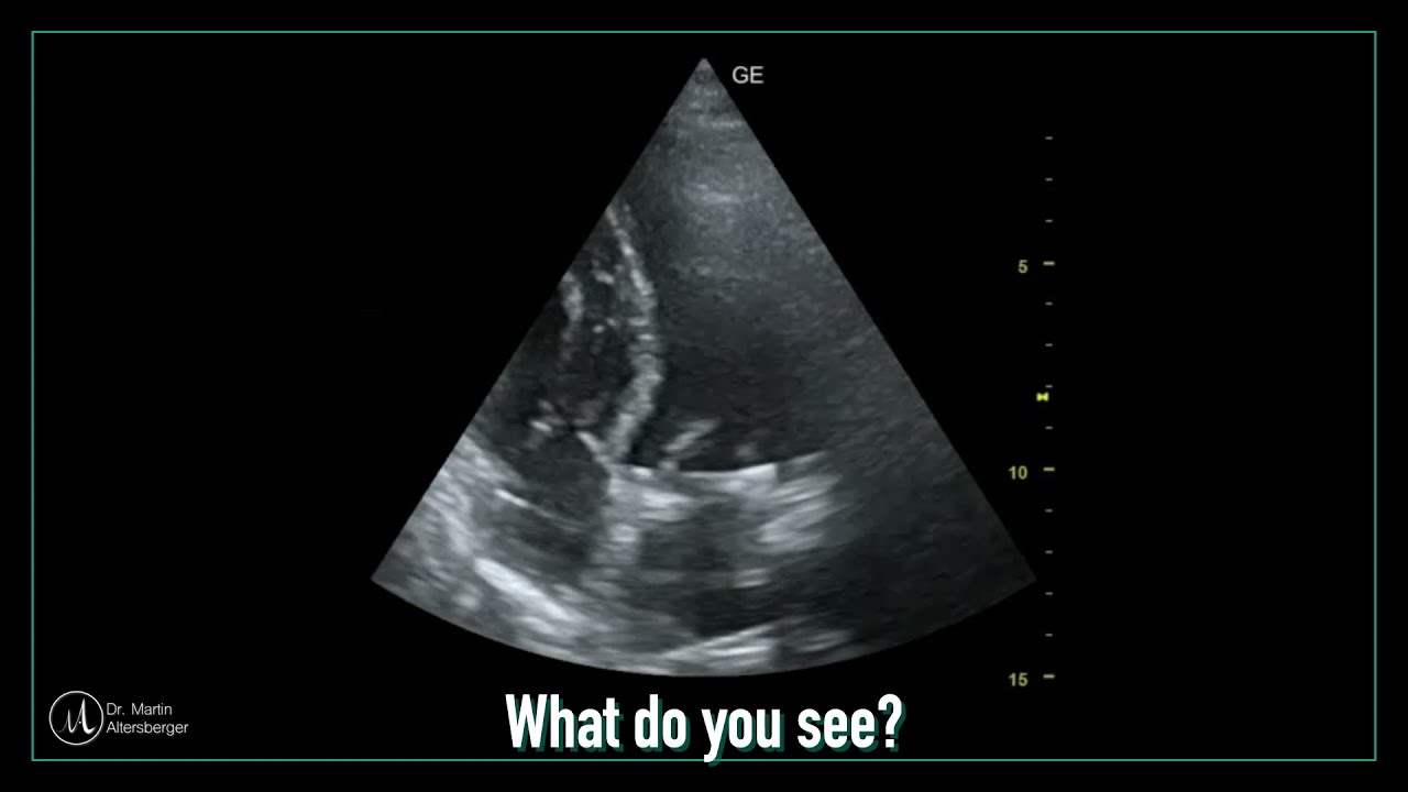 〖Ultrsound〗 Septal shift & septal bounce? - YouTube