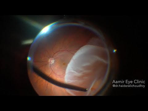 Chandelier Vitrectomy for Retinal Detachment - YouTube