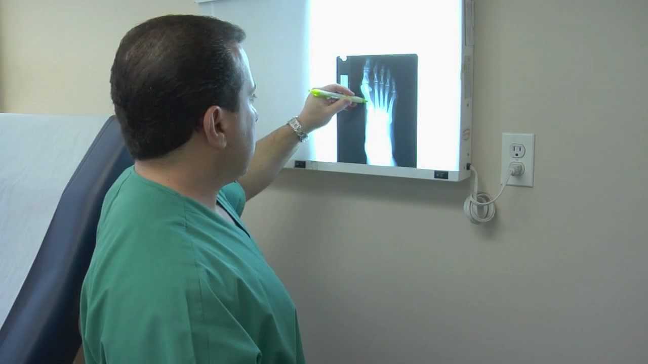 Slimline Bunion Surgery NYC - New York City Podiatrist Dr. Emanuel ...