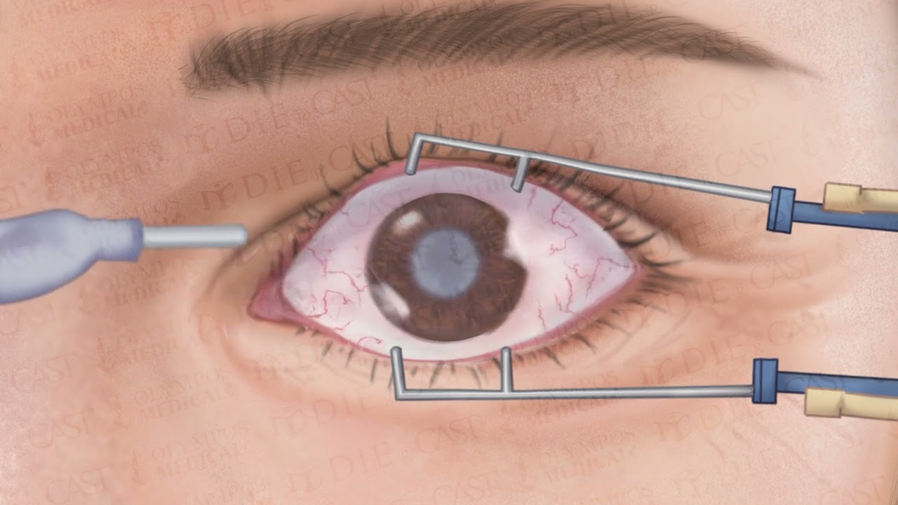 [ASMR] 한눈에 보는 백내장 수술 과정 애니메이션 / cataract surgery animation - YouTube