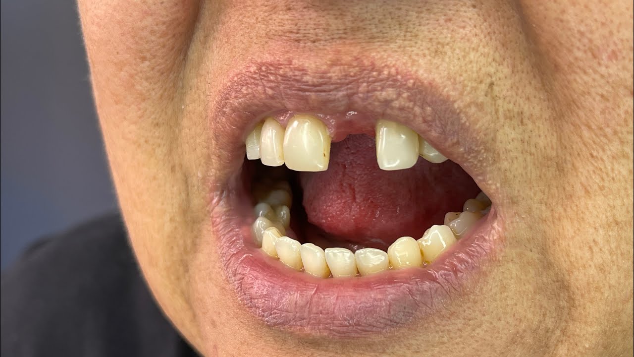 Prosthesis with natural and flexible teeth - YouTube