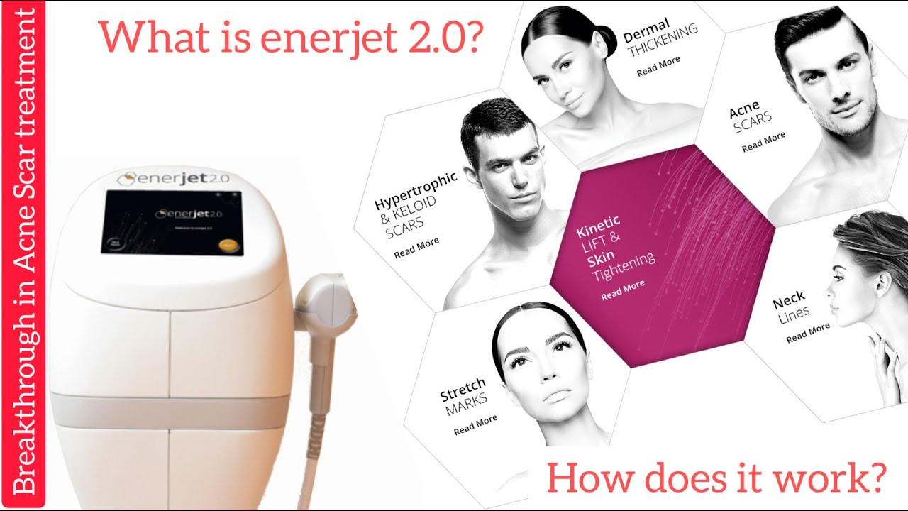 What is Enerjet 2.0? | How Does it work? | Acne Scars | Indications ...