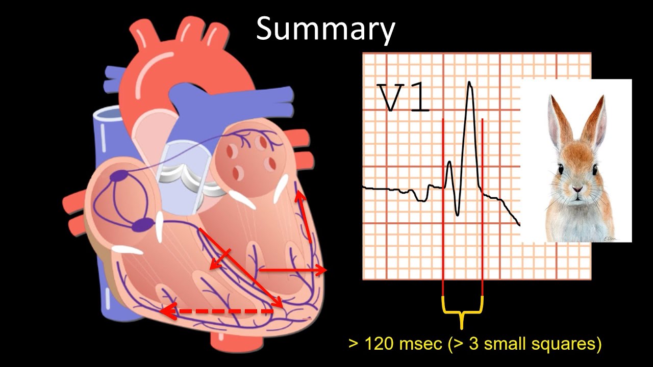 How to Read an ECG: Right Bundle Branch Block (RBBB) - YouTube