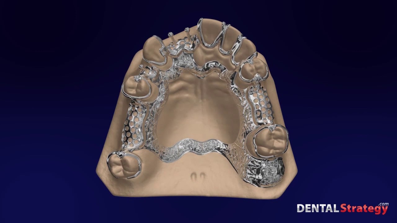 213 - Upper RPD Class II mod 4 - YouTube