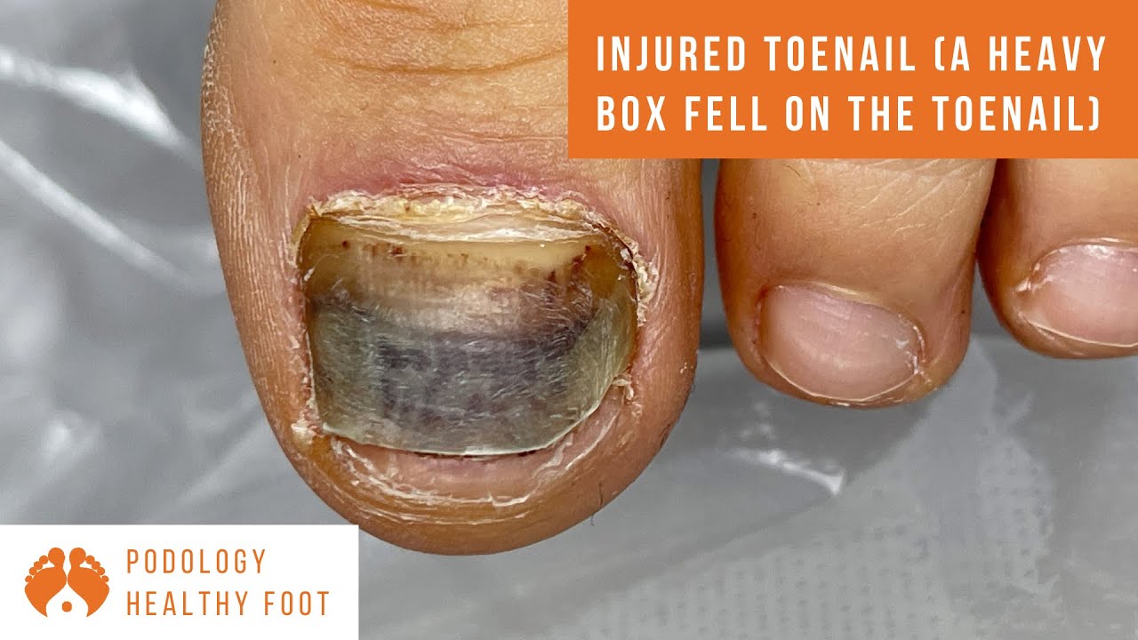 Injured toenail a heavy box fell on the toenail ***asmr treating an ...