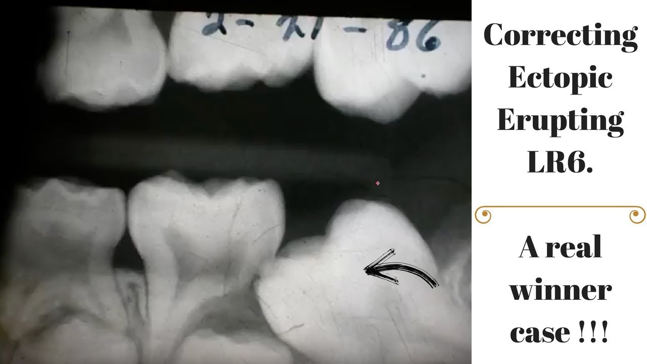 Correcting Ectopic Erupting LR6. A real winner case !!! - YouTube