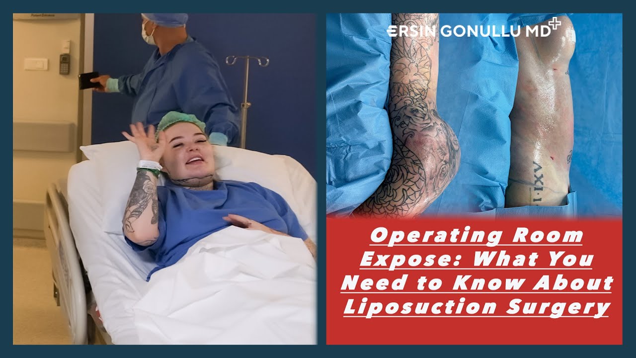 Operating Room Expose: What You Need to Know About Liposuction Surgery ...