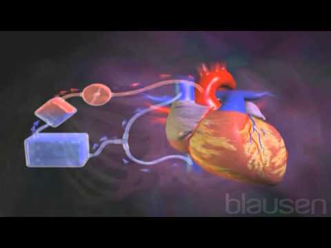 Bypass cardiaco - YouTube