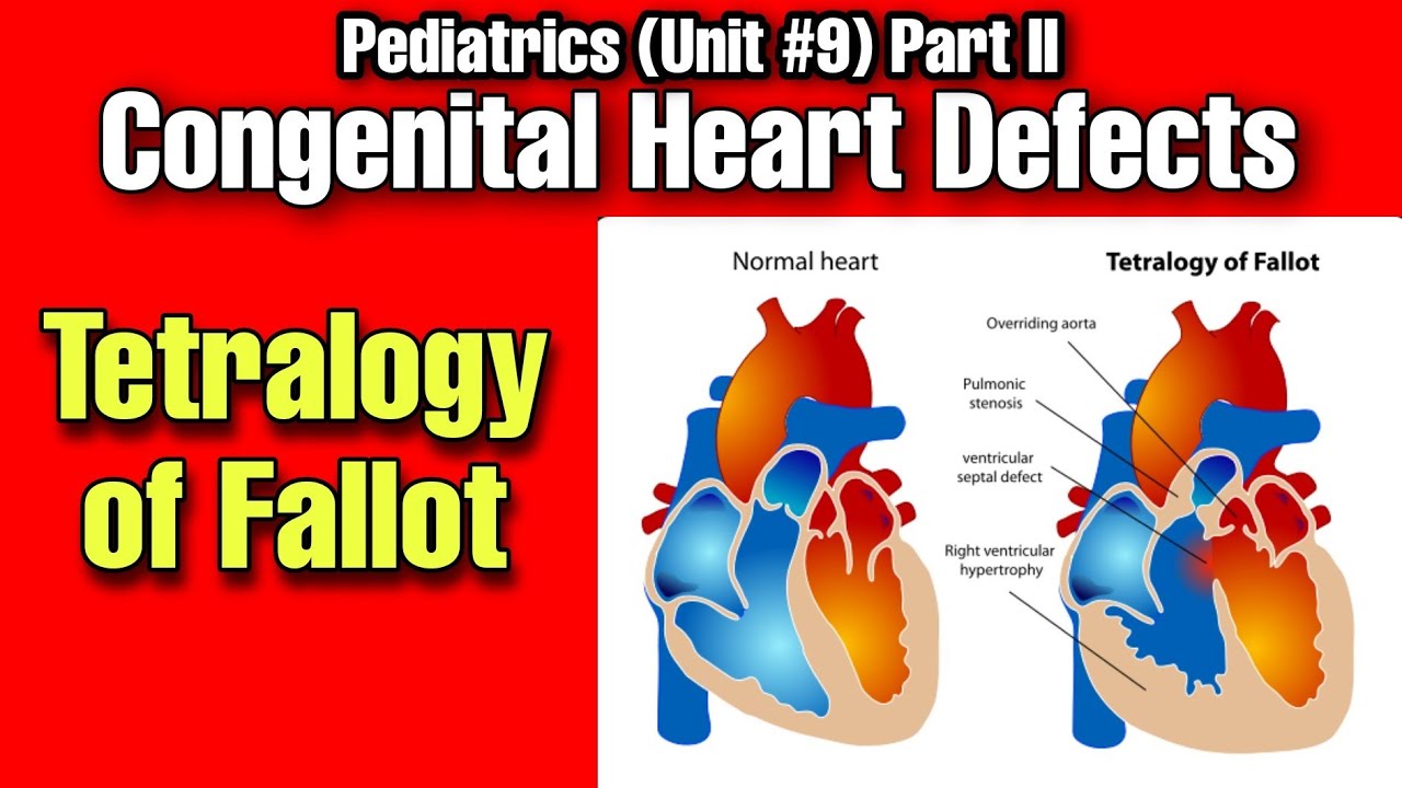 Obstructive Heart Defects:A Guide to Tetralogy of Fallot,Stenosis and ...