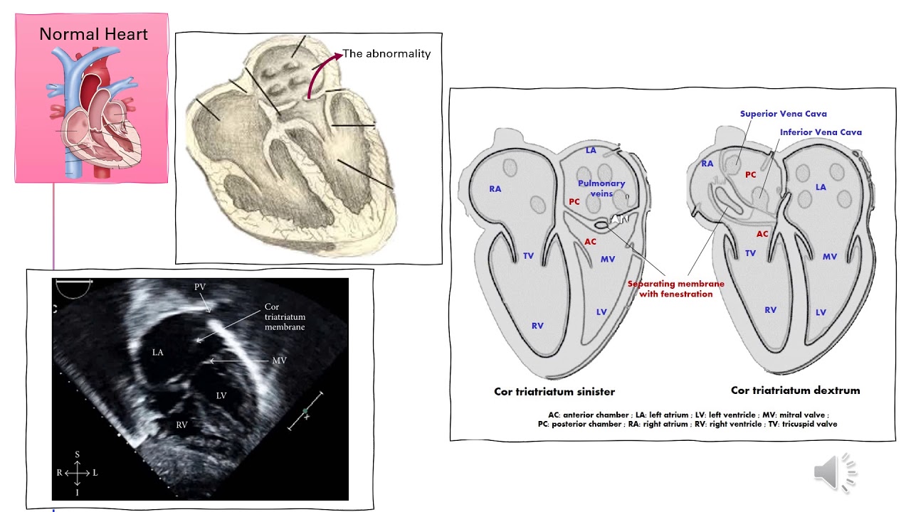 Pediatric Cor Triatriatum - YouTube