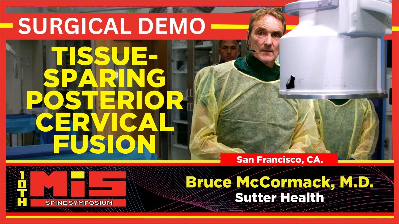 Tissue Sparing Posterior Cervical Fusion - Bruce McCormack, M.D. - YouTube