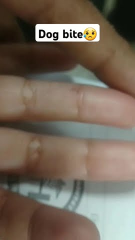 autistic child dog bite #autism #autismawarenes #shorts #shortvideo ...