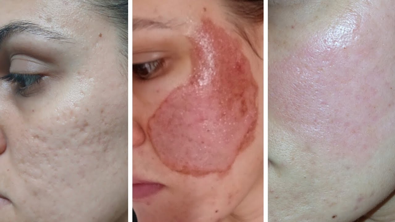 ️ Peeling ATA/TCA 40% em casa - 1° aplicação Como fiz e o resultado ...