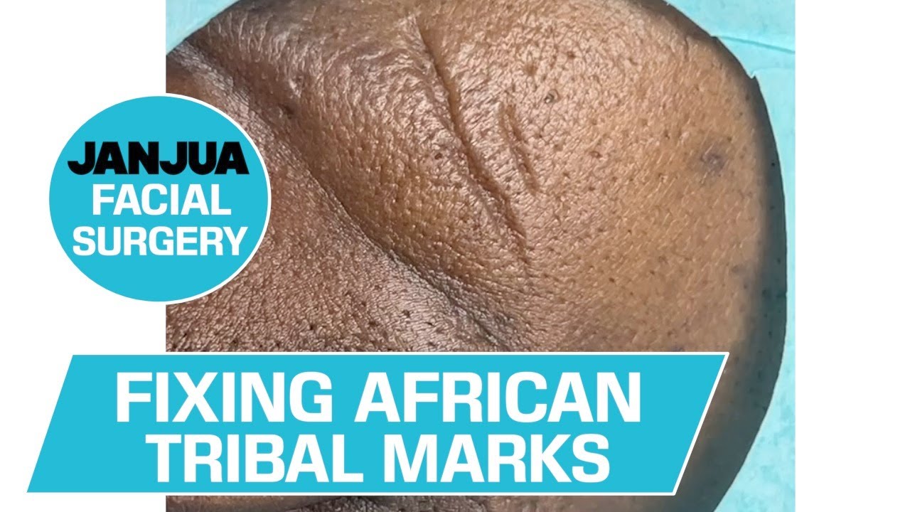 FIXING AFRICAN TRIBAL MARKS - SCAR REVISION - DR. TANVEER JANJUA - NEW ...