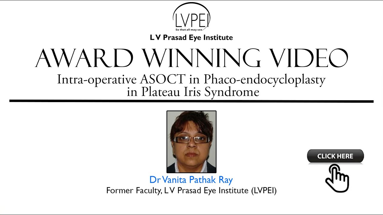Intra - operative ASOCT in Phaco - endocycloplasty in Plateau Iris ...