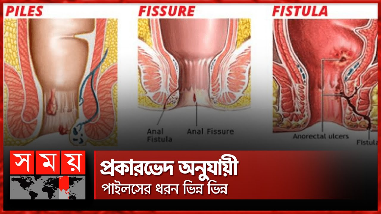 পাইলস, ফিসার ও ফিস্টুলার মধ্যে পার্থক্য কী? | Piles | Fissure | Fistula | Somoy TV - YouTube