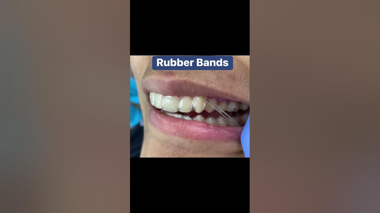 Invisalign Rubber Bands - YouTube
