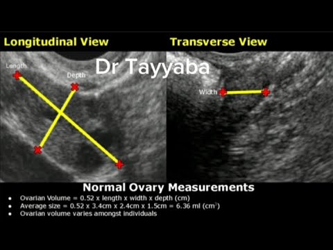 How To Measure Ovarian Volume on Ultrasound|Ovary Length, Width, Depth ...