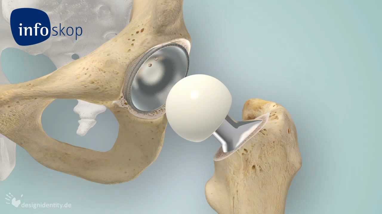 Totalendoprothese am Hüftgelenk, schematische Darstellung - YouTube