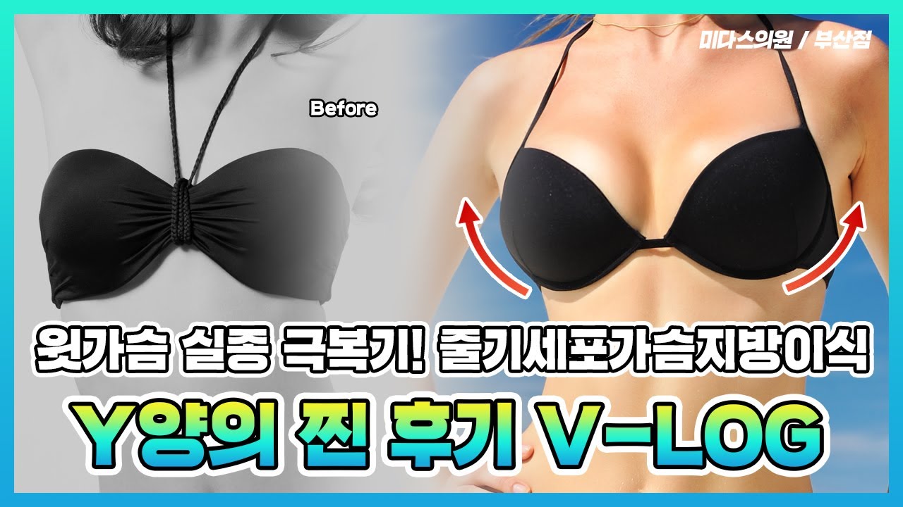 부산점 윗가슴 실종 극복기 찐 브이로그 I 줄기세포 가슴지방이식 I 현실적인 후기를 들고왔어유~💛 줄기세포가슴성형 줄기세포가슴이식 Youtube