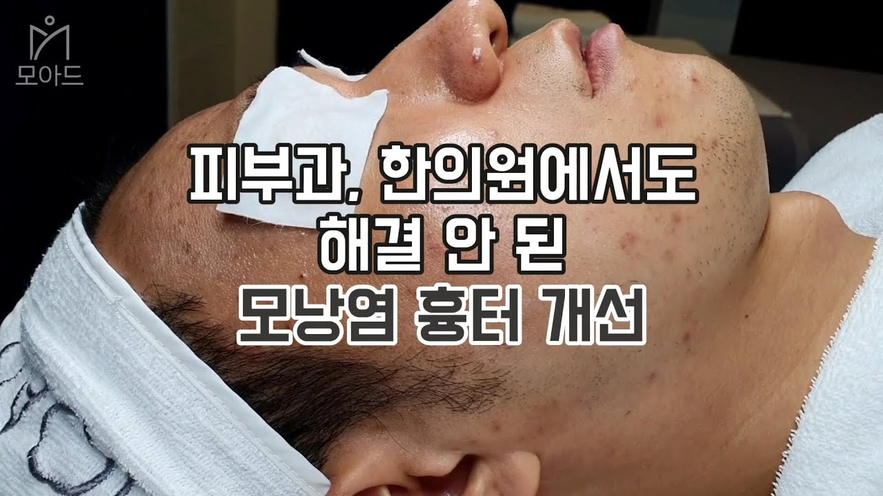 피부과 한의원에서도 해결 안 된 모낭염 흉터 개선 후기 건대 피부관리 모아드 Acne Scars Skin Care