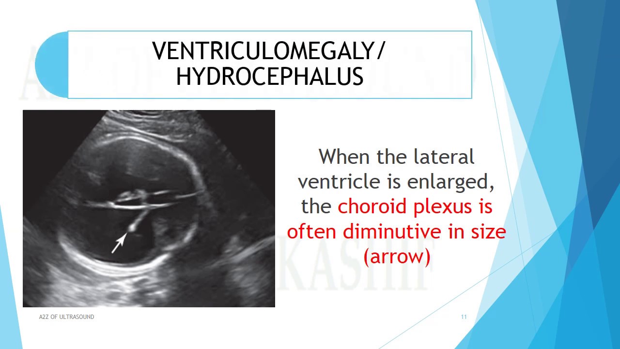 Hydranencephaly Ultrasound