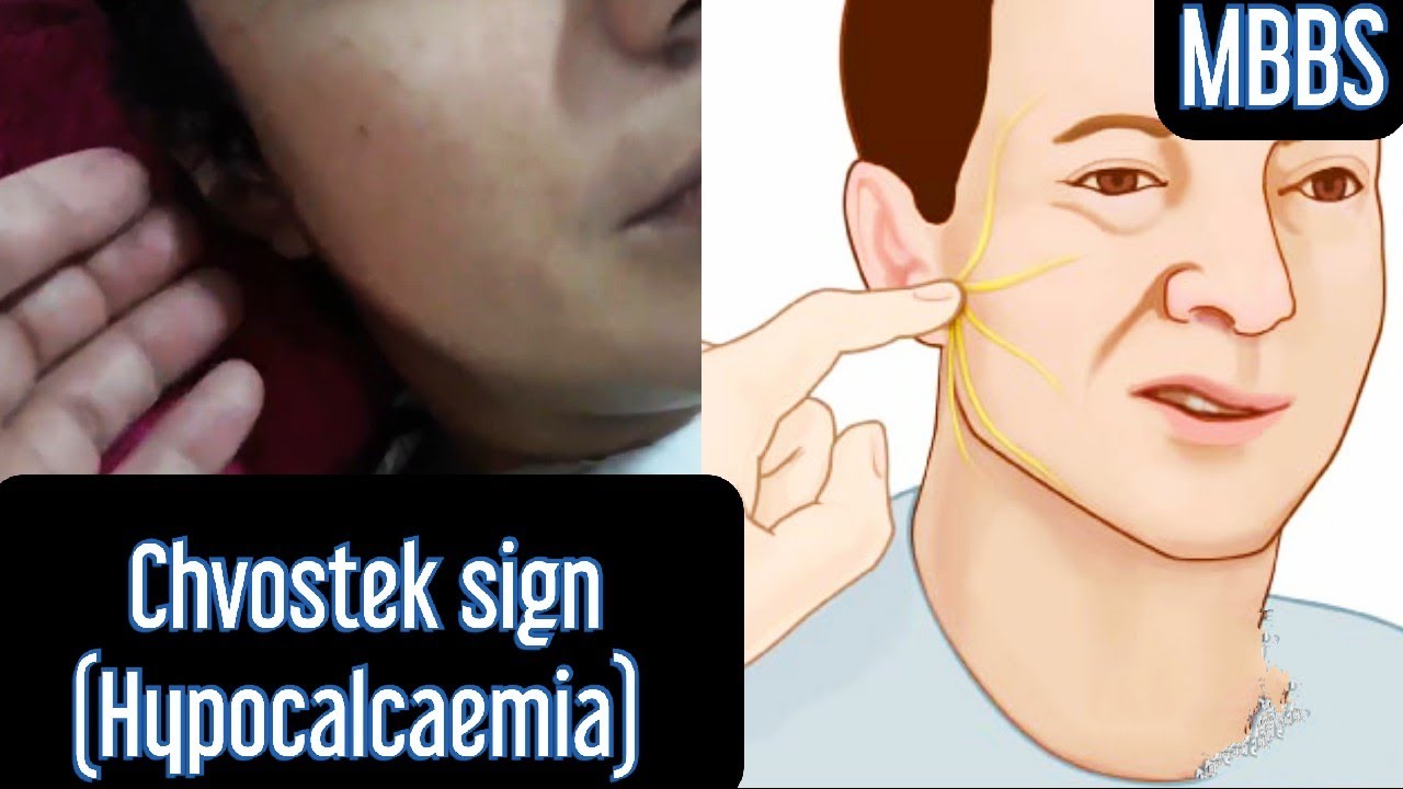 Chvostek sign seen in Hypocalcaemia #mbbs #medicine #neet #neetpg#usmle ...
