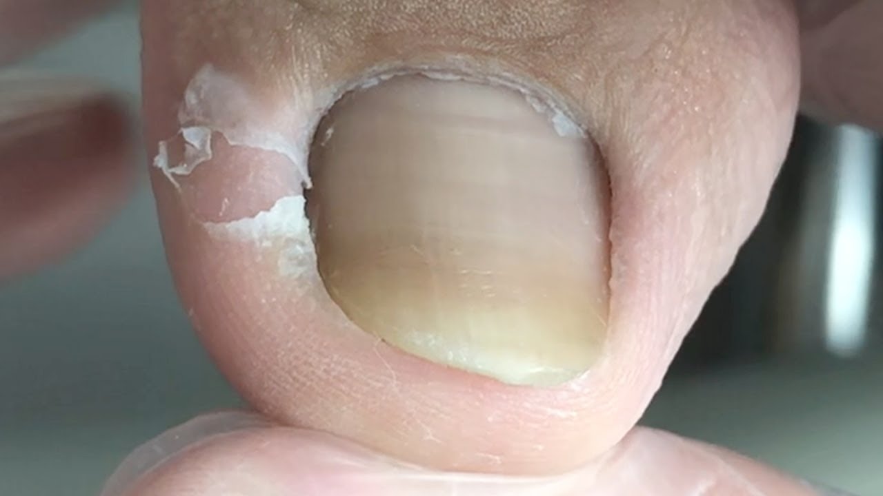 Perfectly Trimmed Long Toenails: A Pedicure Tutorial【DrZhang】 - YouTube