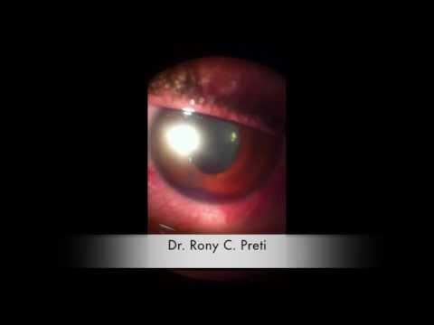 hifema (hyphema) trauma ocular Dr Rony C Preti - YouTube