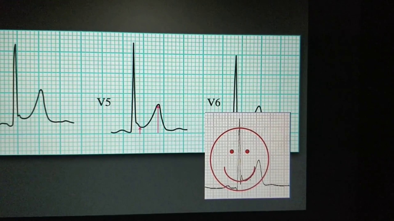 Myocardial ischemia ECG class - YouTube