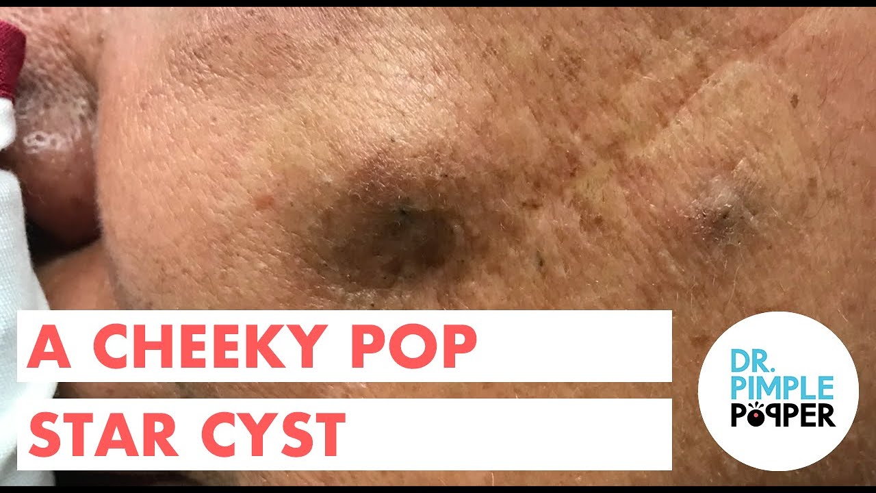 A Cheeky Pop Star Cyst - YouTube