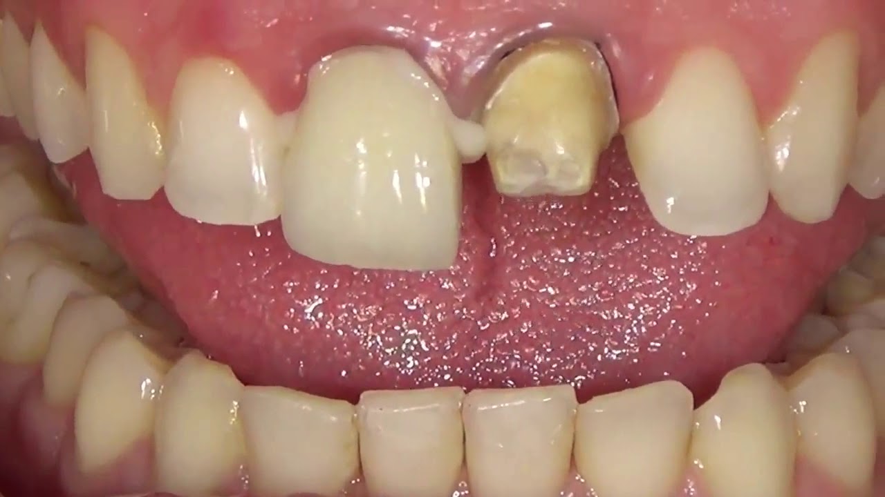 How to use Coltene SoloCem - YouTube