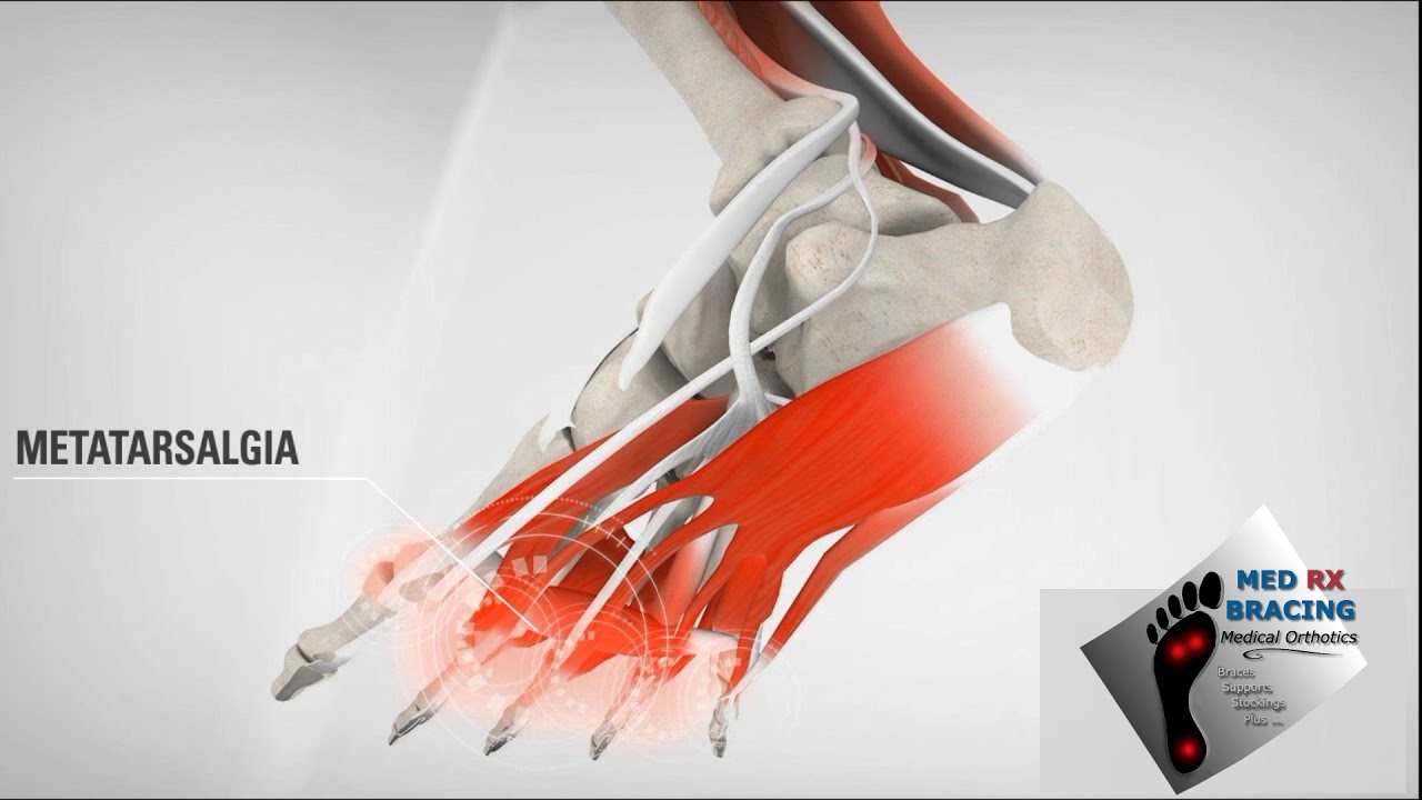 Metatarsalgia - Foot Problems - YouTube