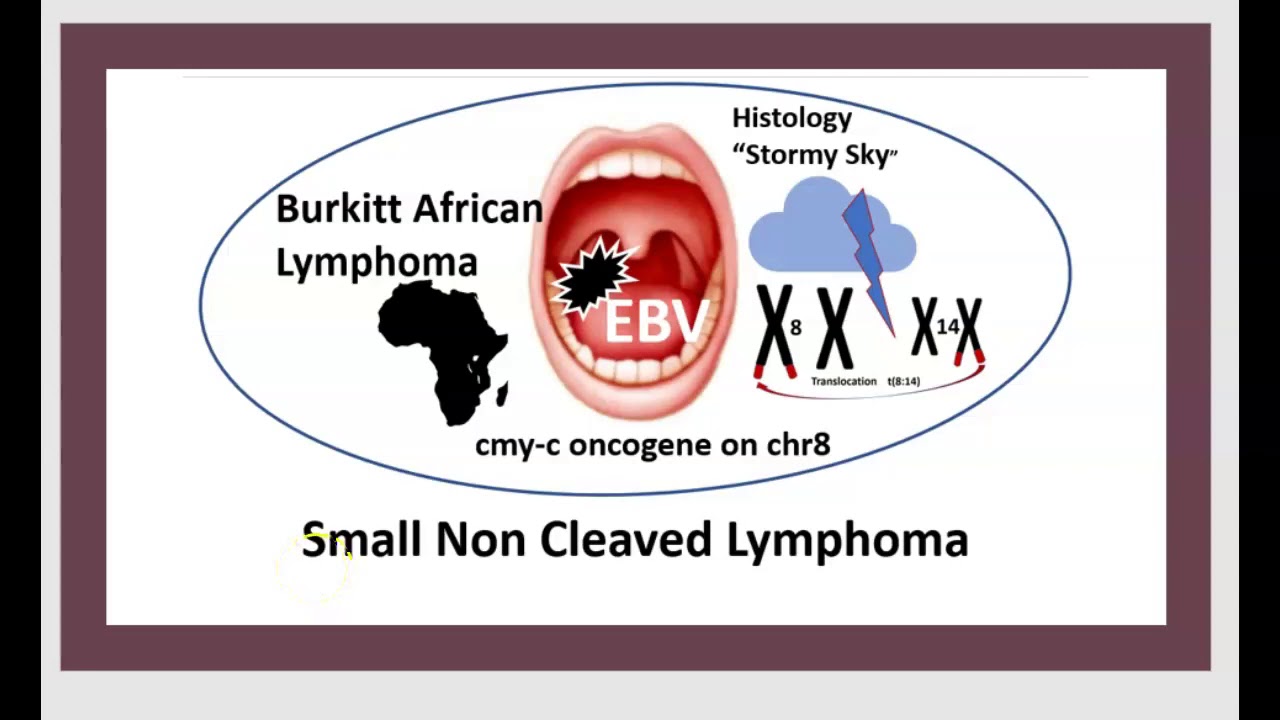 Burkitt Lymphoma Epstein–Barr Virus (EBV) Staging Non-Hodgkin lymphoma ...