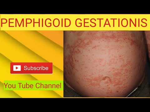 PEMPHIGOID GESTATIONIS - YouTube
