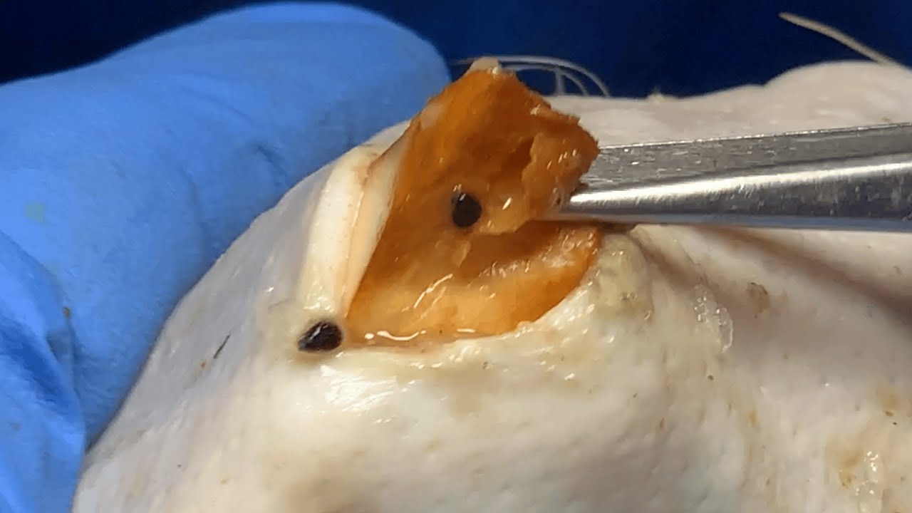 Satisfying Pimple Popping ASMR | Giant Zit & Blackhead Extraction Close ...