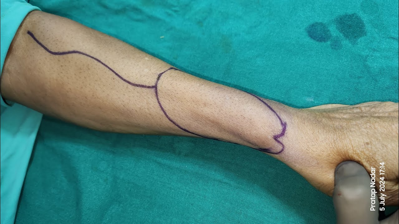 Free Radial Forearm Flap for Tongue Reconstruction - YouTube