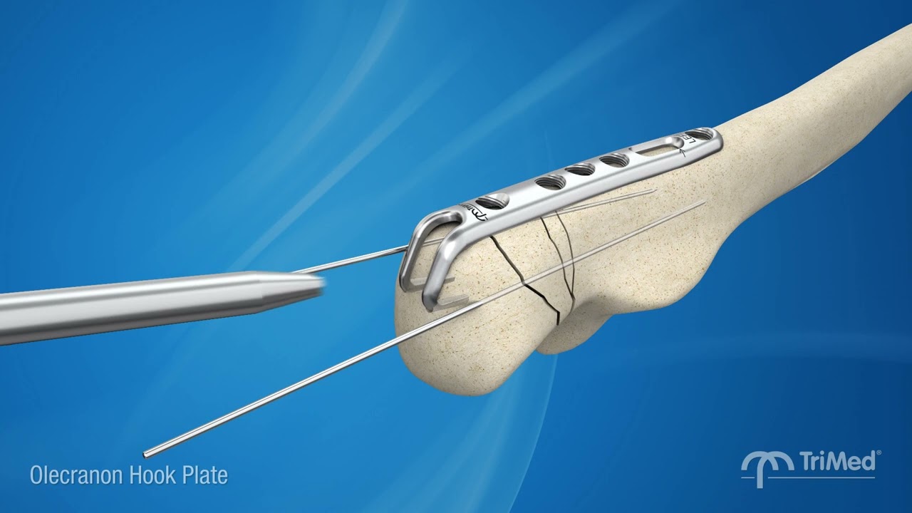 Olecranon Plate