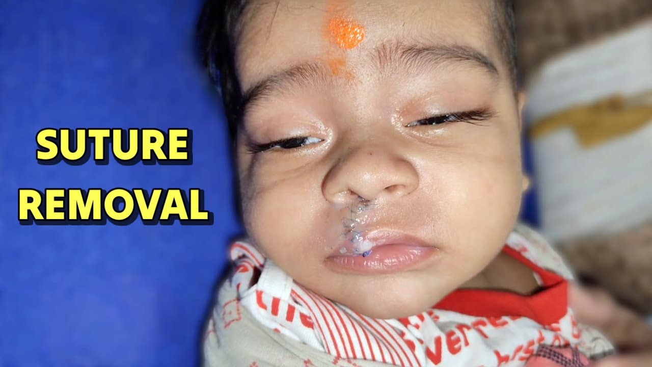 Cleft Lip Repair : Instructions After Suture Removal by Dr Parit Ladani ...
