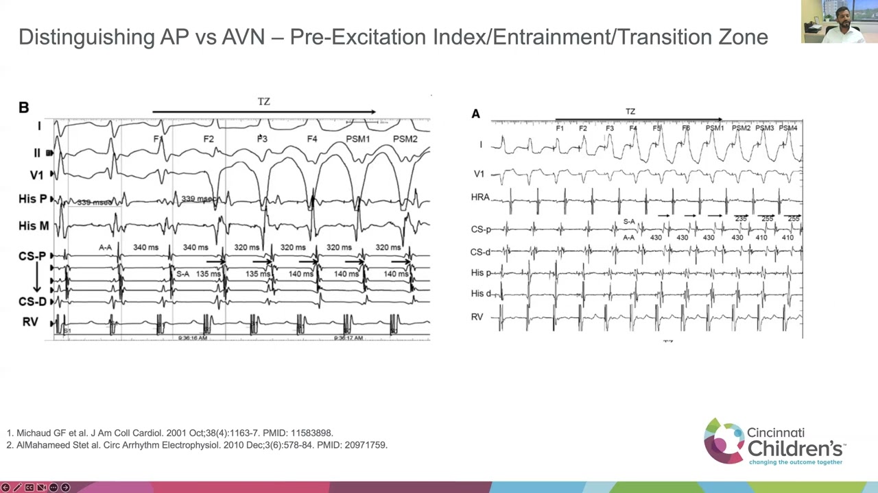 Catheter ablation of difficult pathway locations - YouTube