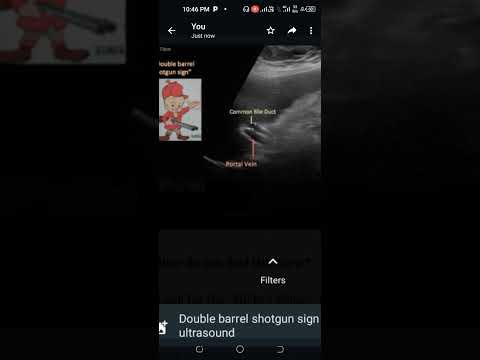 double barrel shotgun sign on ultrasound - YouTube